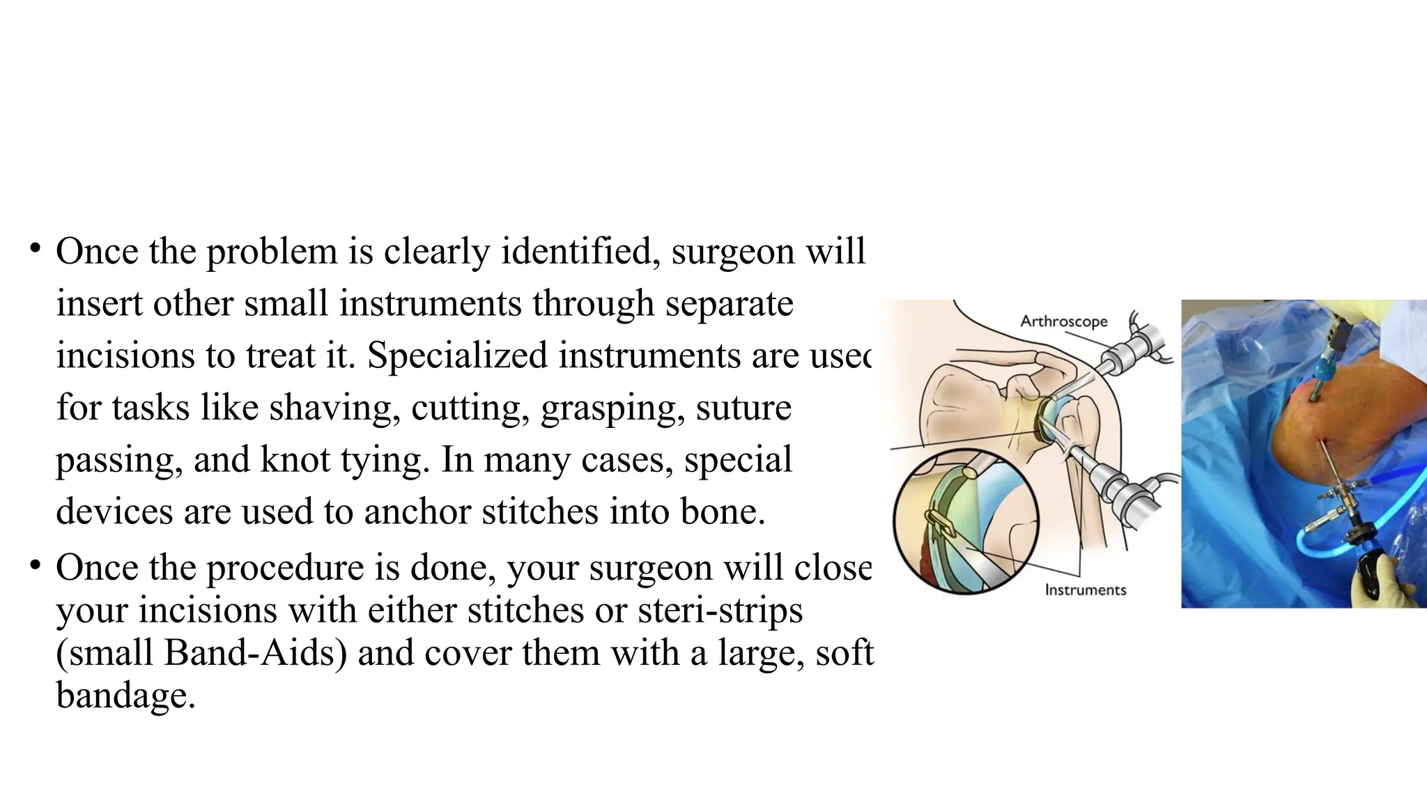 Shoulder Arthroscopy : Procedure.pptx