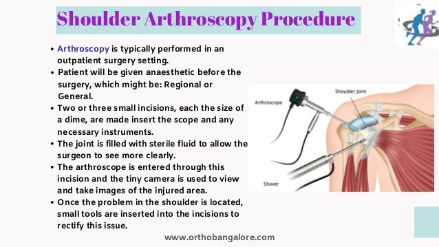 All About Shoulder Arthroscopy Surgery