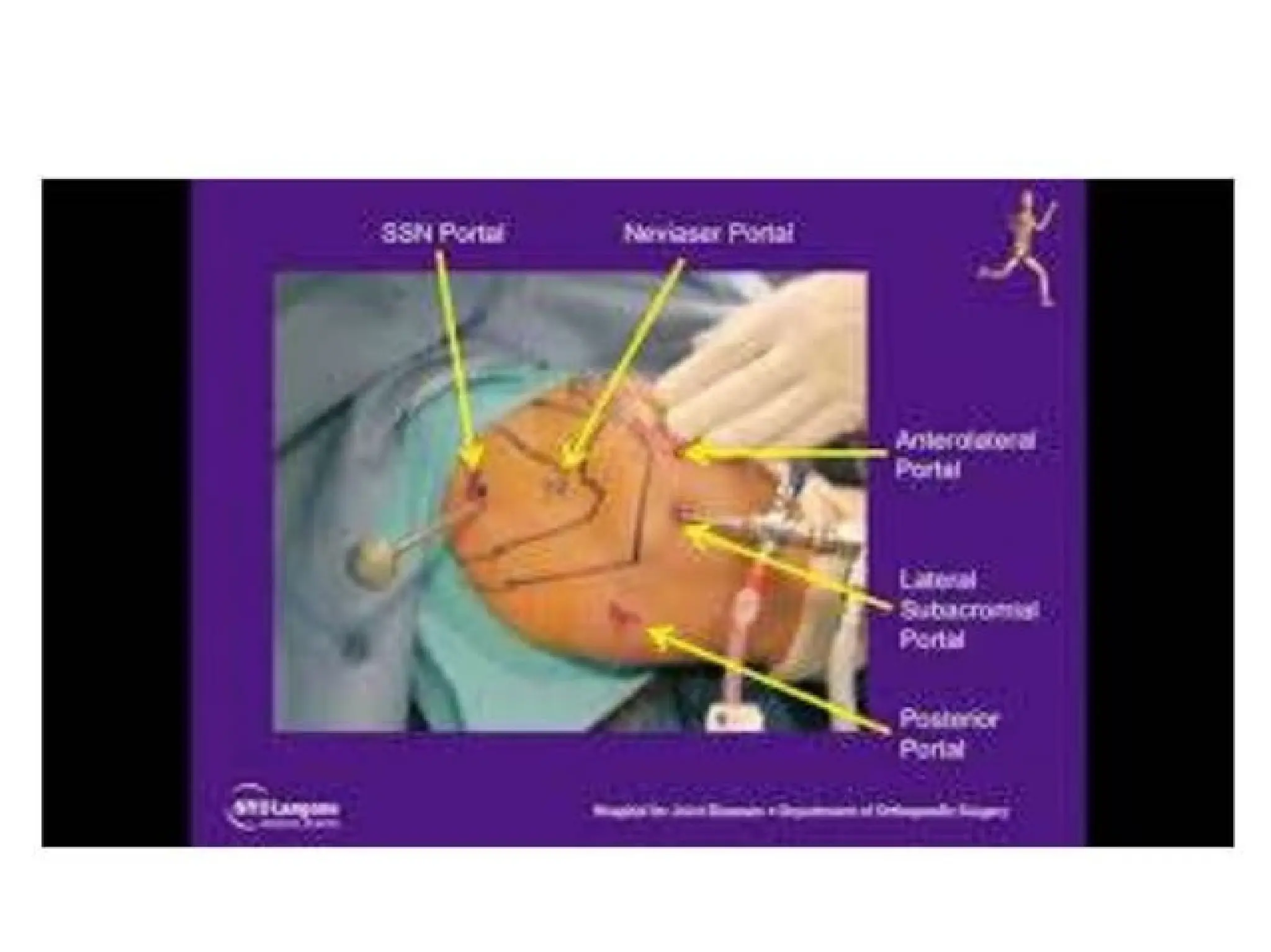 Shoulder arthroscopy portals presentation.pptx