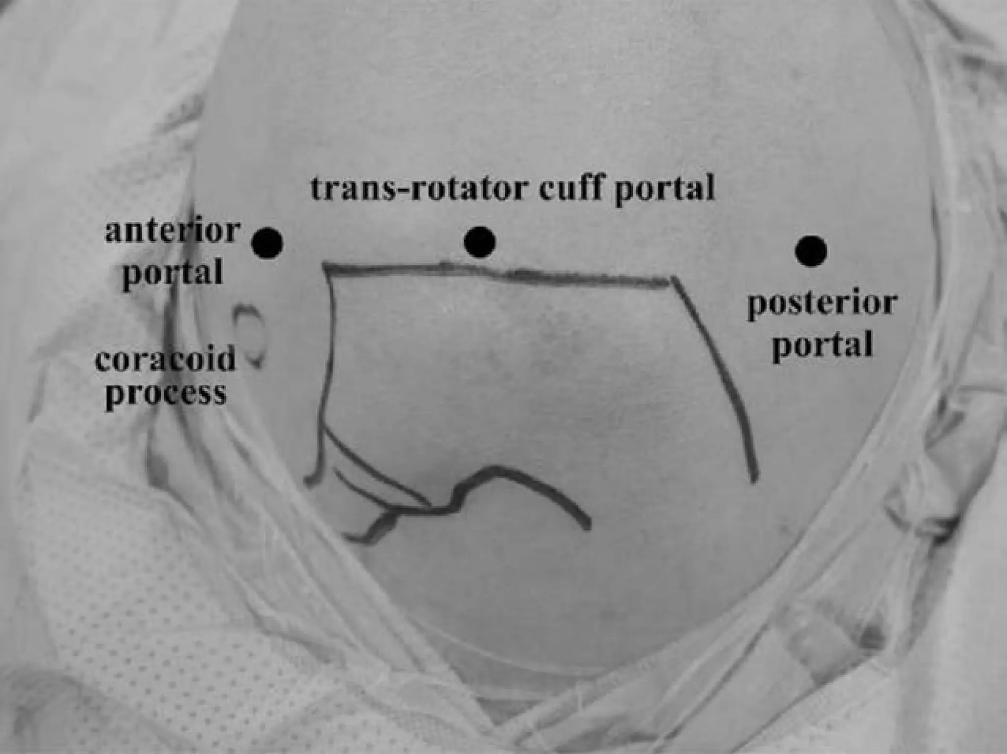 Shoulder arthroscopy portals presentation.pptx
