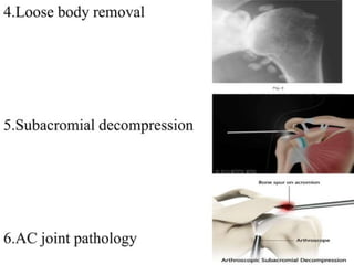 Shoulder arthroscopy portals presentation.pptx