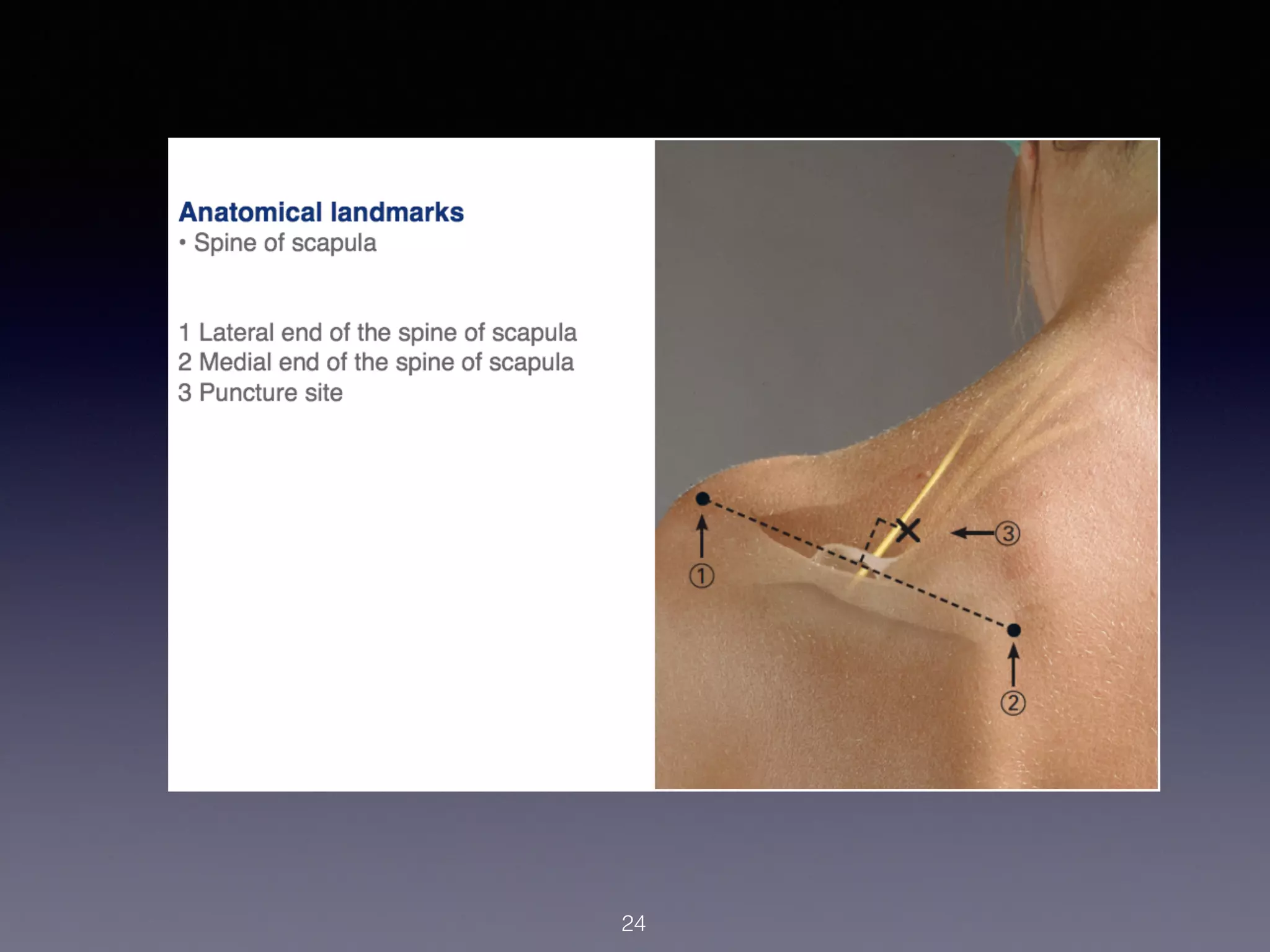 Shoulder block tutorial 2014 | PPT