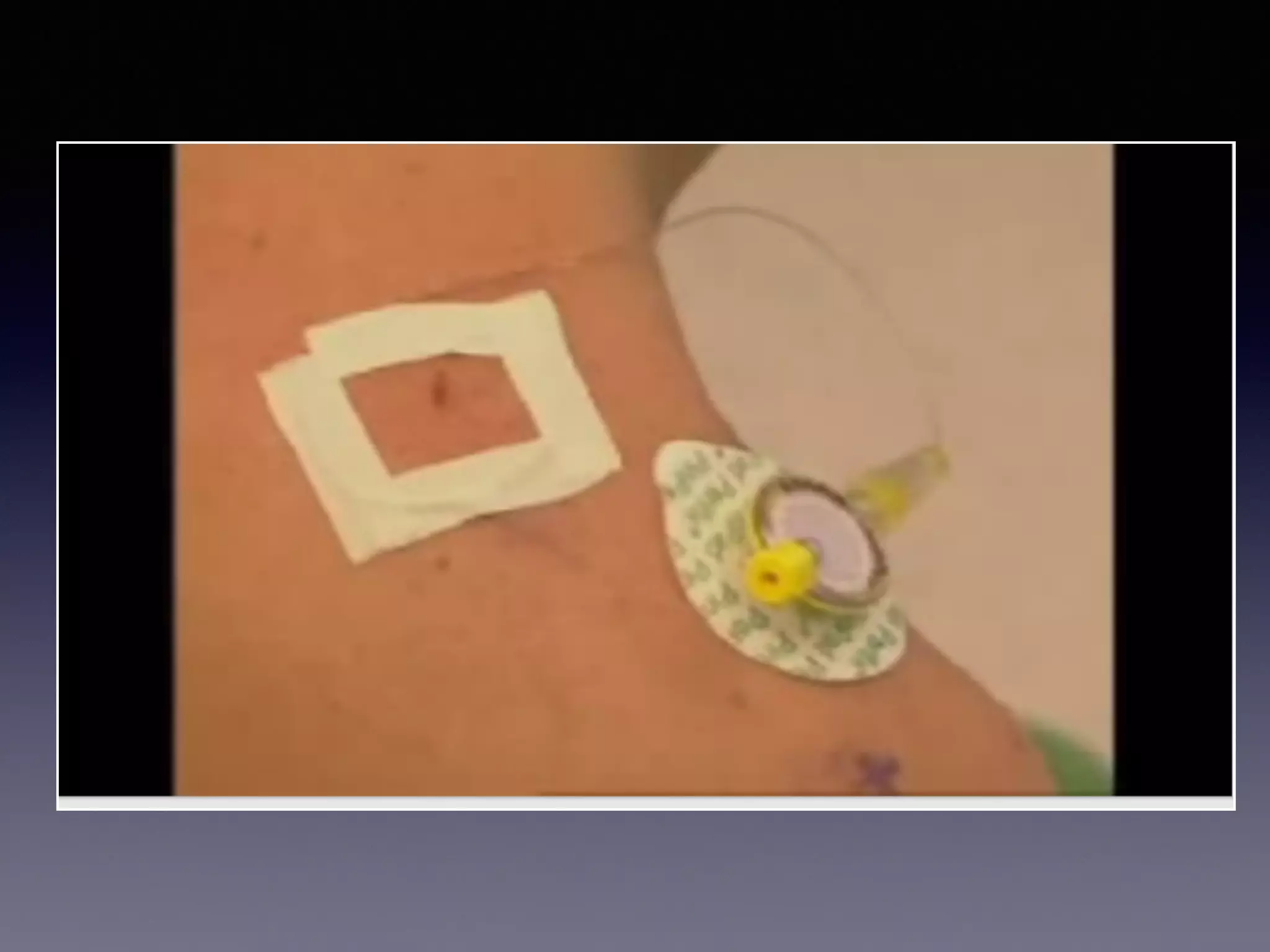 Shoulder block tutorial 2014 | PPT