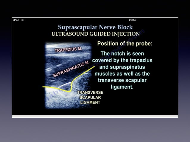 Shoulder block tutorial 2014 | PPT