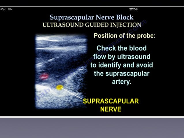 Shoulder block tutorial 2014 | PPT