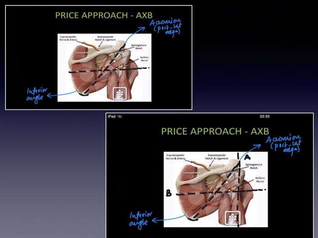 Shoulder block tutorial 2014 | PPT