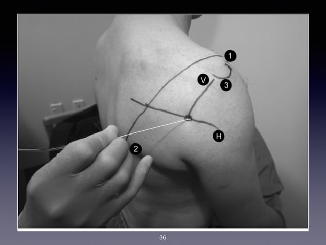 Shoulder block tutorial 2014 | PPT
