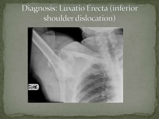 Luxatio Erecta Inferior Shoulder Dislocation | PPTX