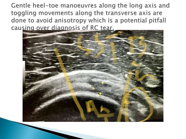 Shoulder Diagnostic Ultrasound.pptx