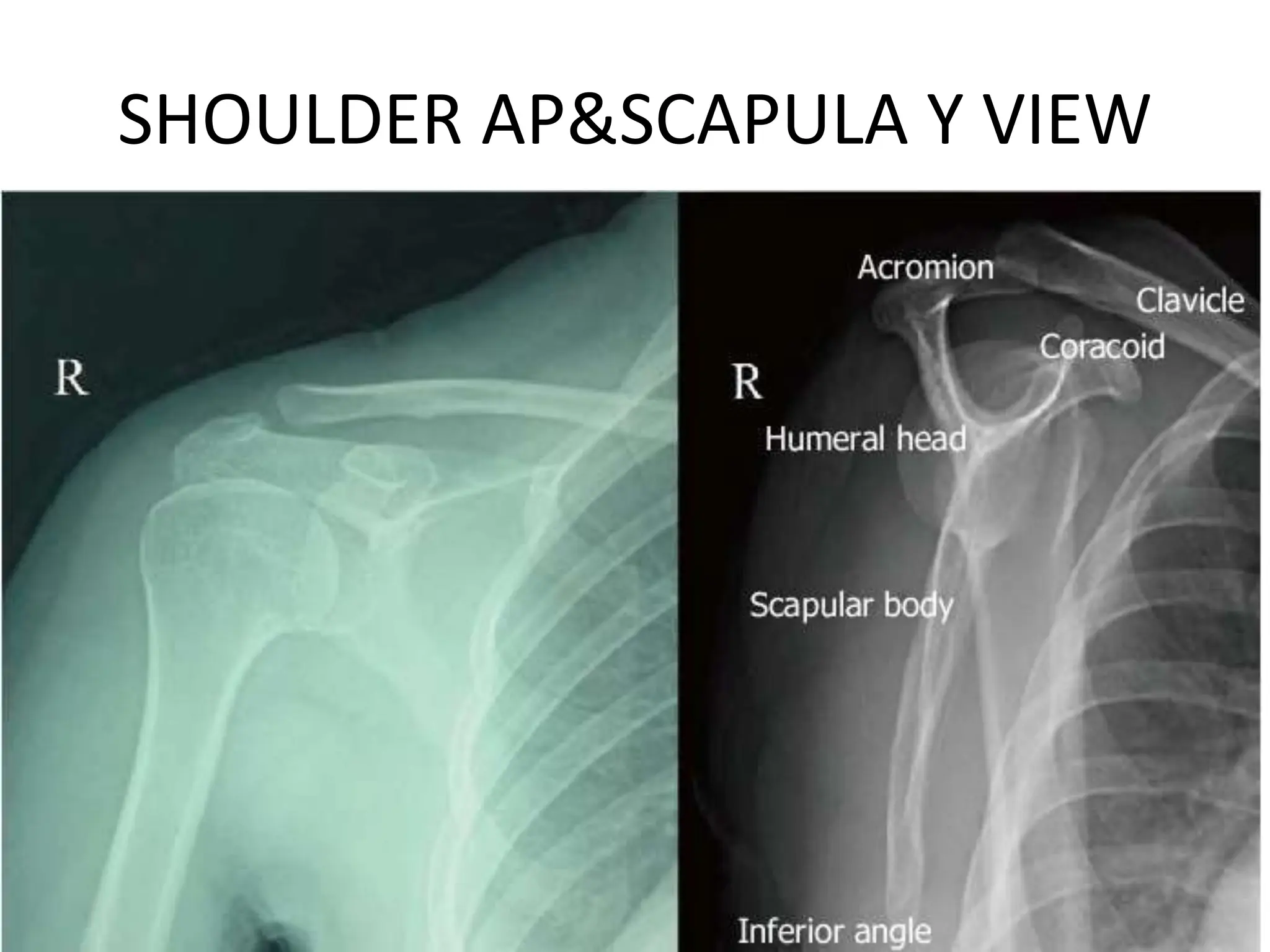SHOULDER DISLOCTION FOR HOMOEOPATHIC (SURGERY) | PPTX