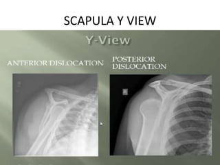 SHOULDER DISLOCTION FOR HOMOEOPATHIC (SURGERY) | PPTX