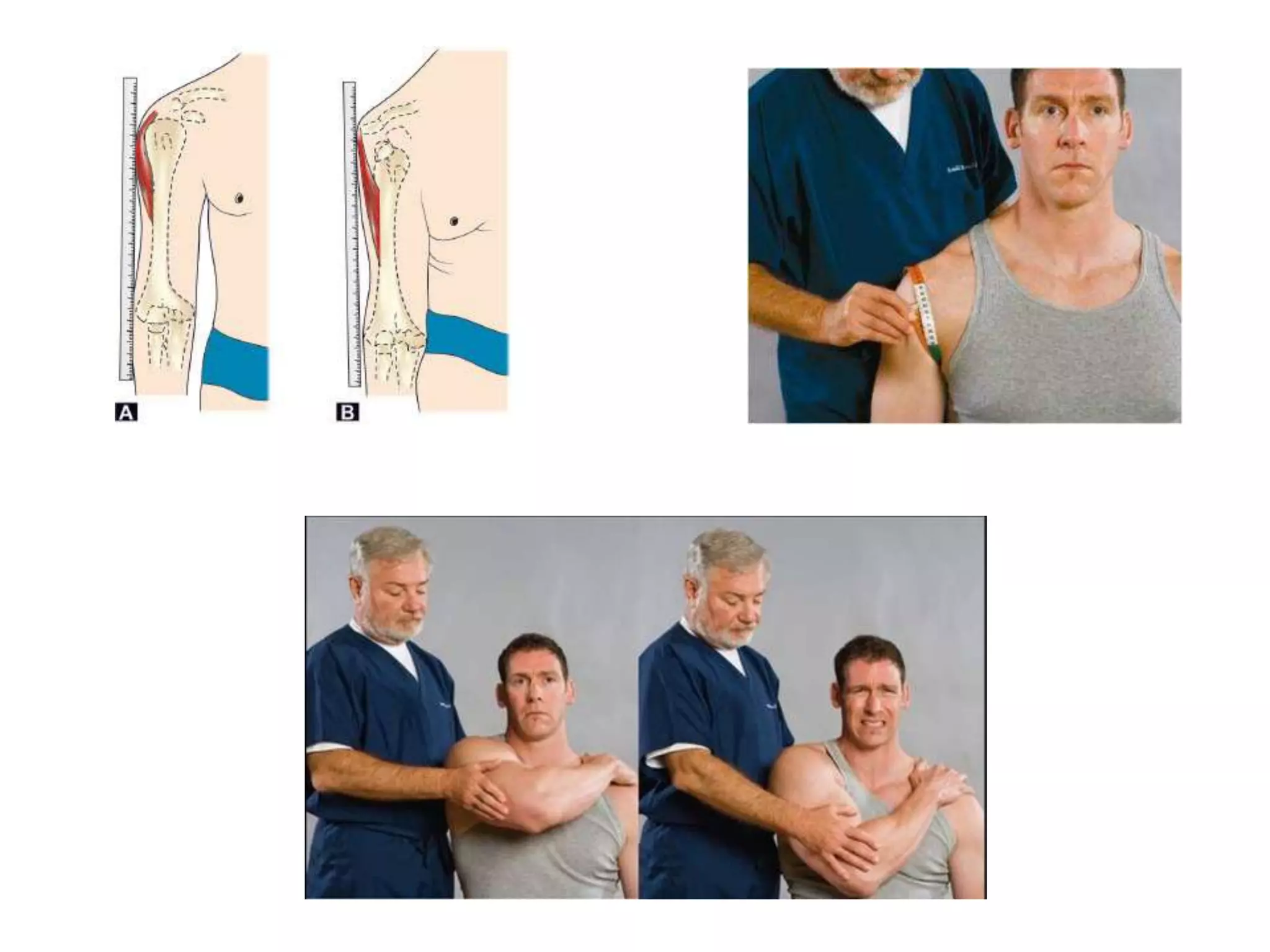Shoulder disloaction | PPTX