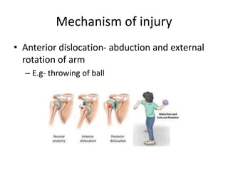 Anterior Shoulder Dislocation Mechanism Of Injury