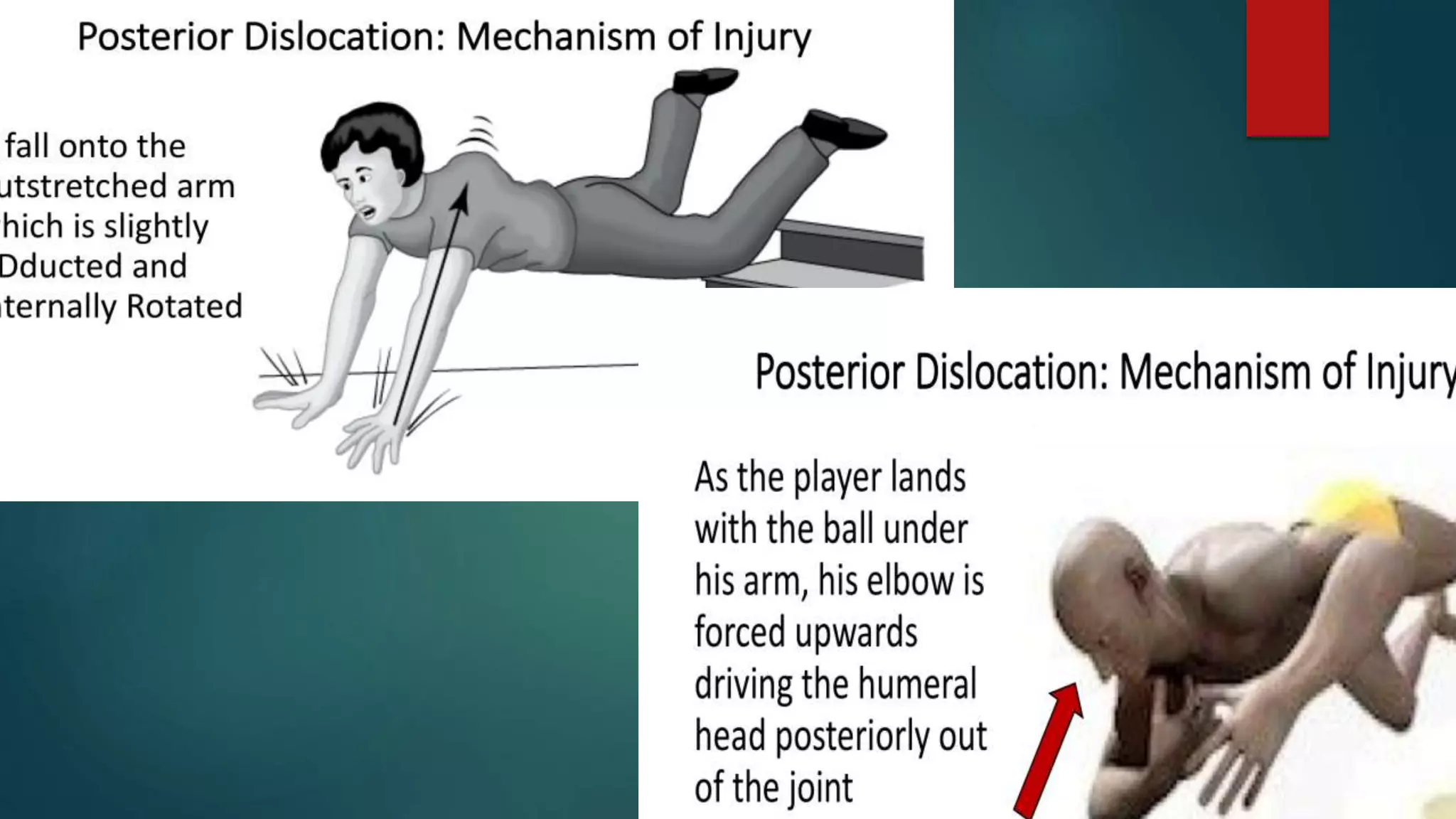SHOULDER DISLOCATION-1.pptx
