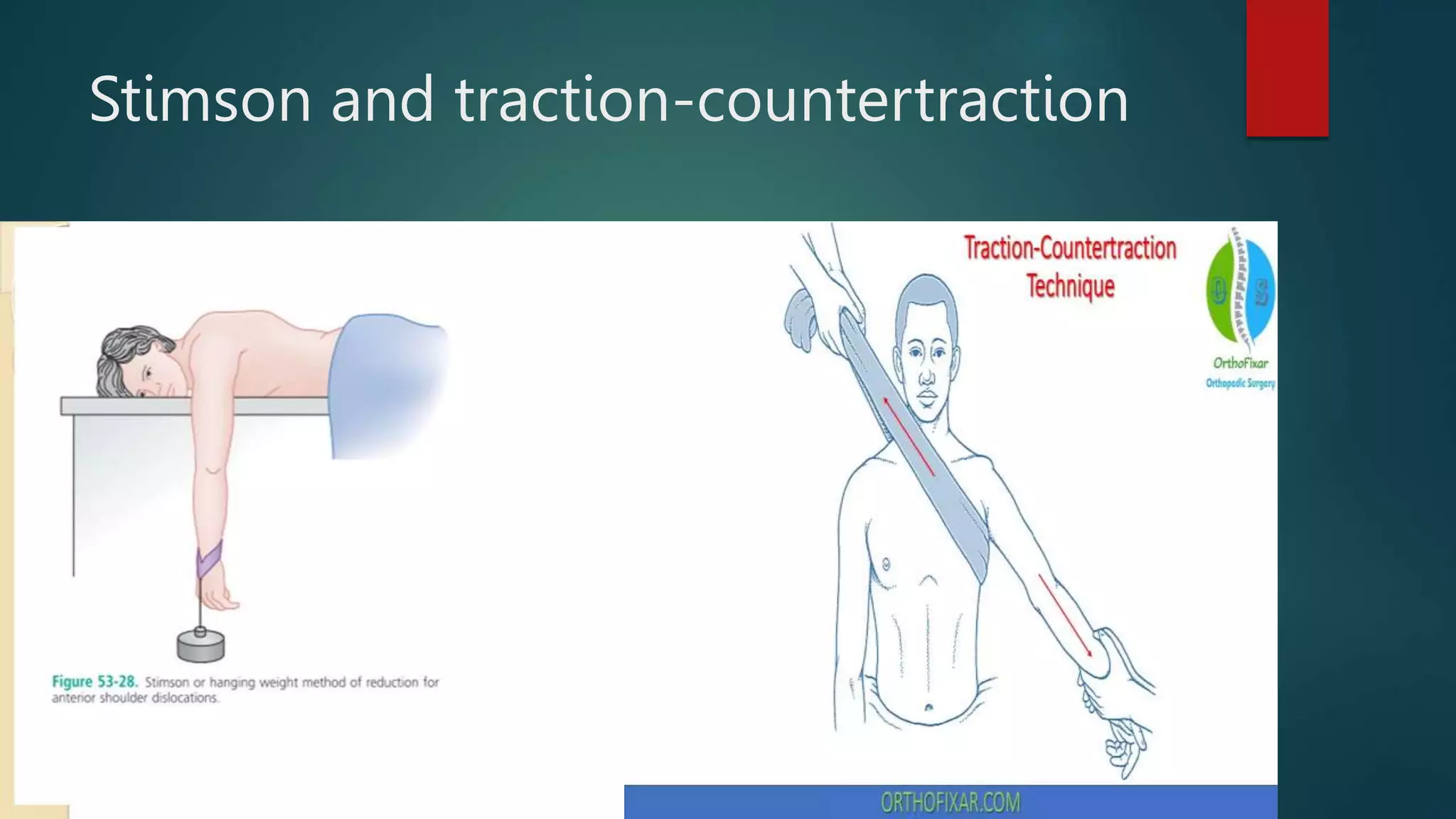SHOULDER DISLOCATION-1.pptx