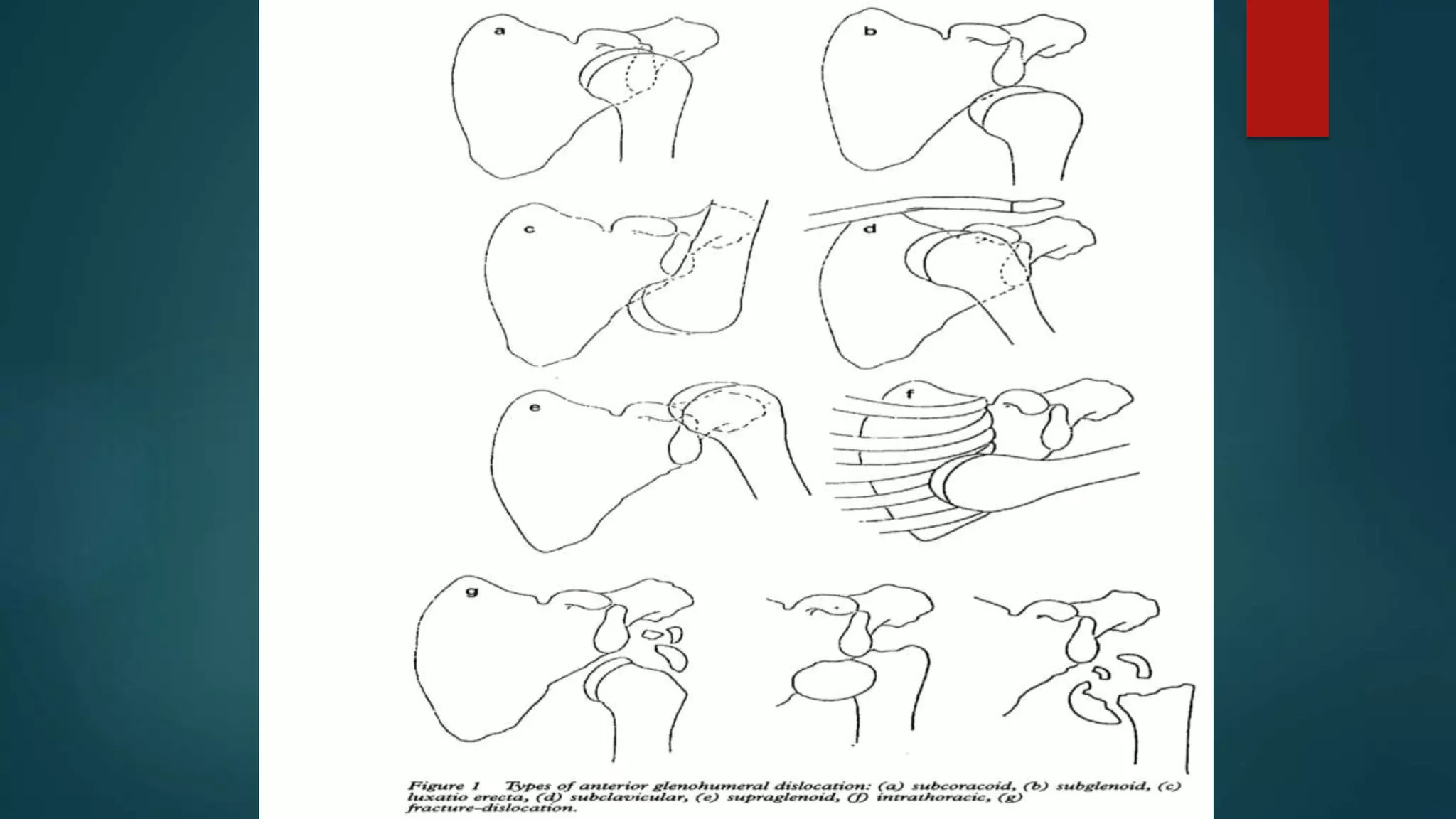SHOULDER DISLOCATION-1.pptx