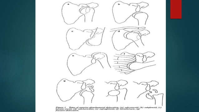 SHOULDER DISLOCATION-1.pptx