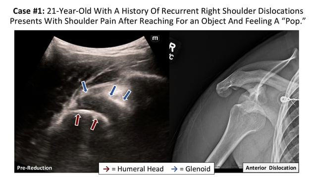 Shoulder Dislocations - Orthopedic Radiologic Imaging | PDF