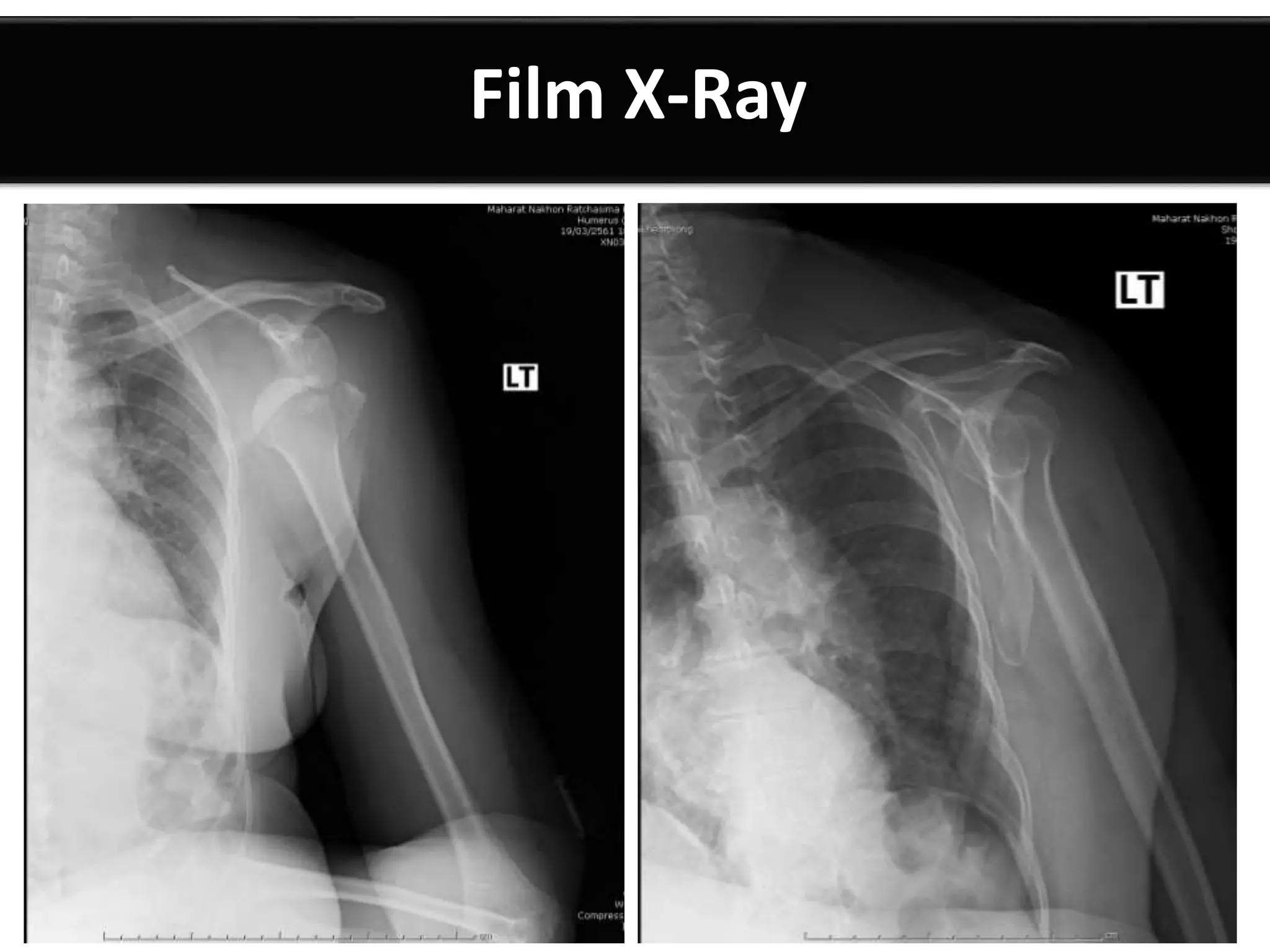 Shoulderdislocation Pptx