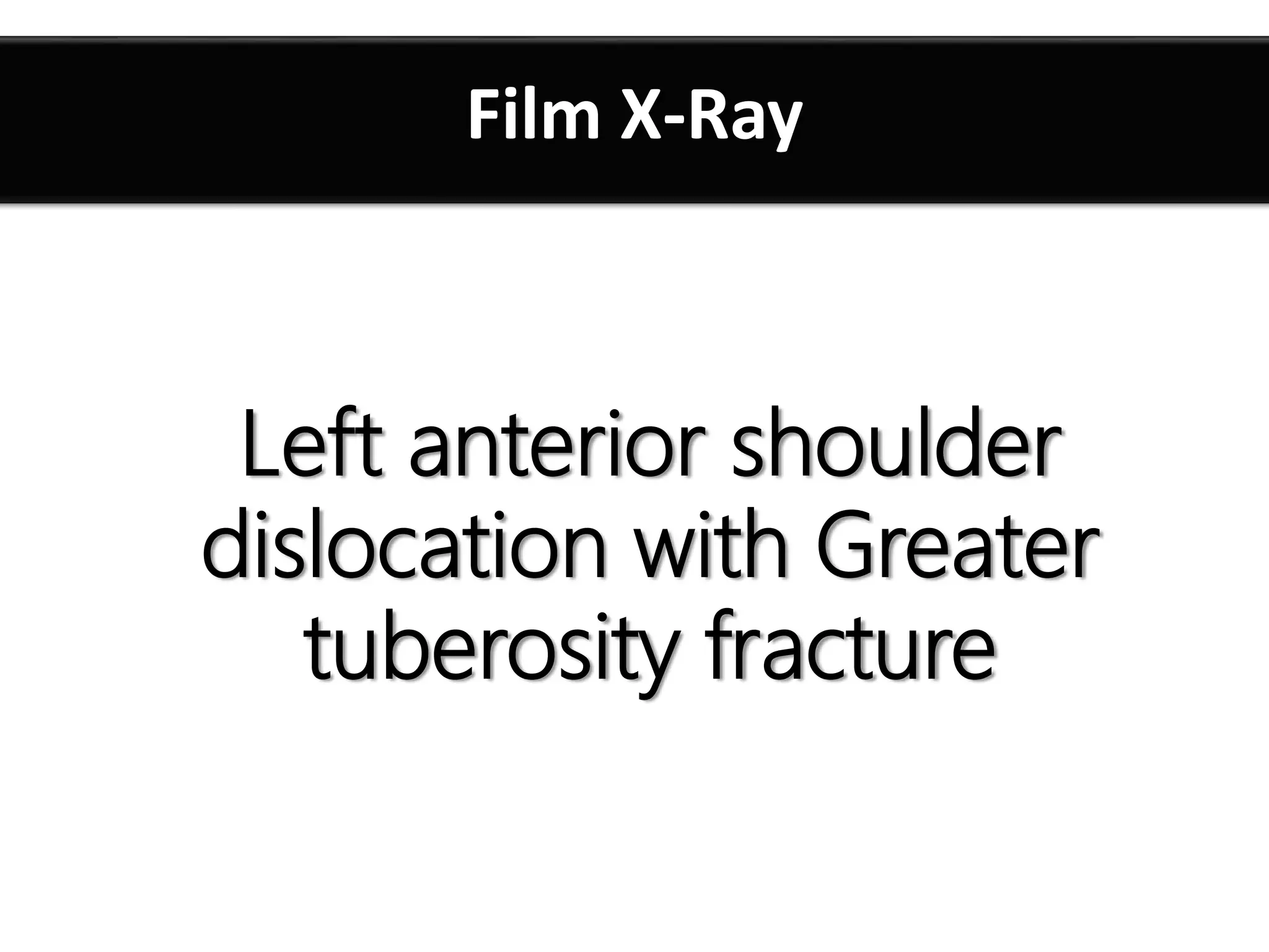 Shoulderdislocation | PPTX