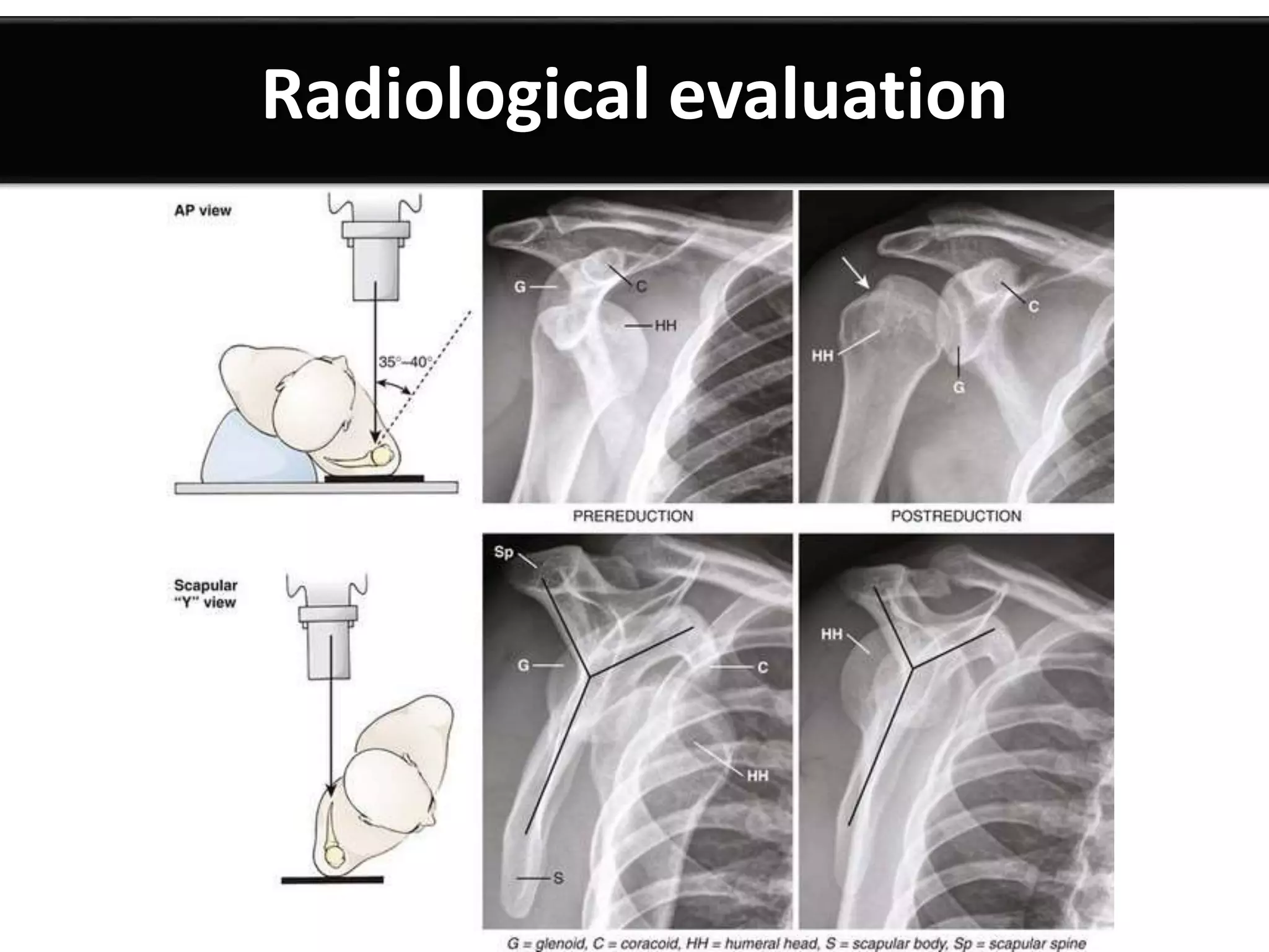 Shoulderdislocation Pptx