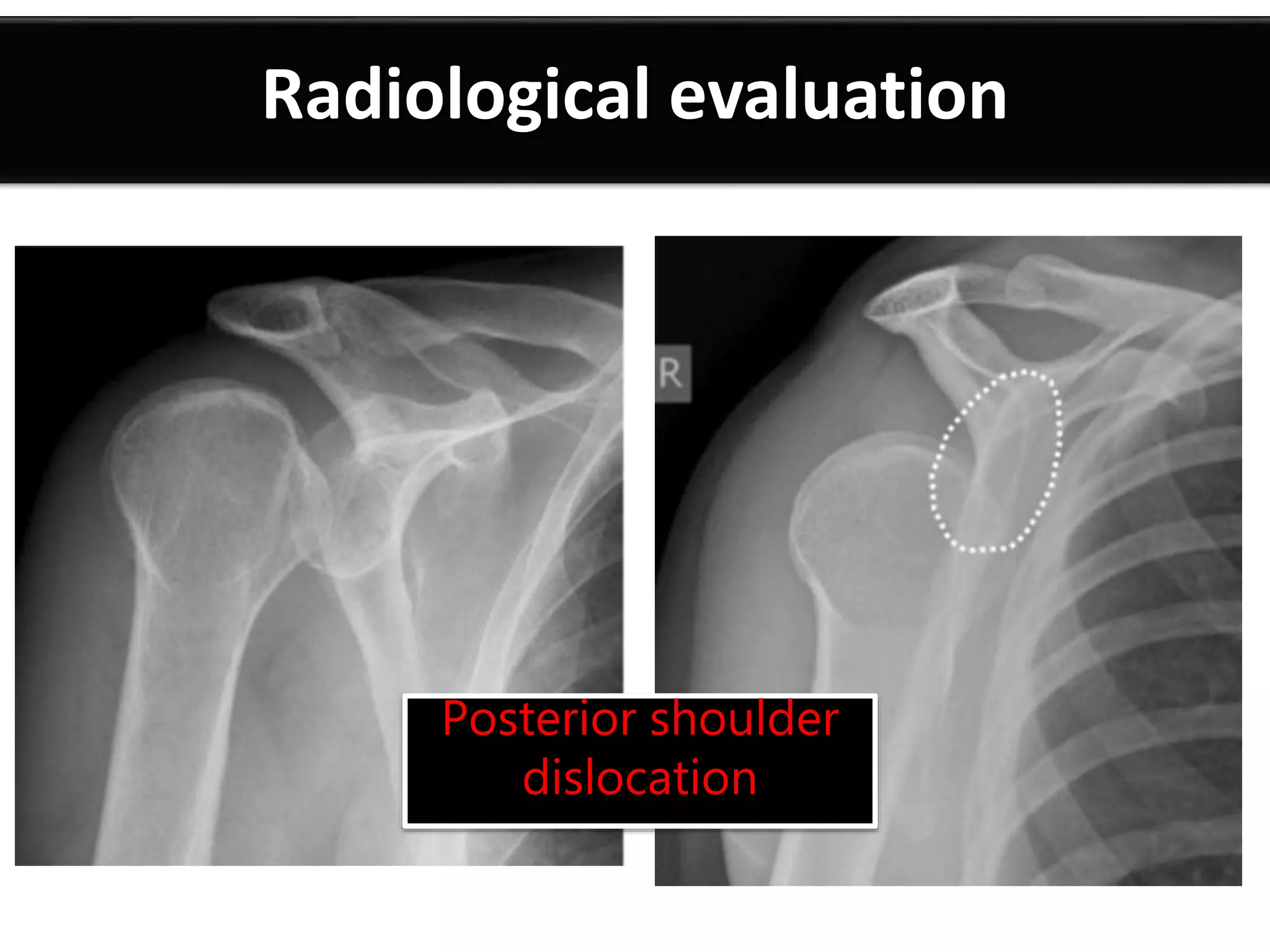 Shoulderdislocation Pptx