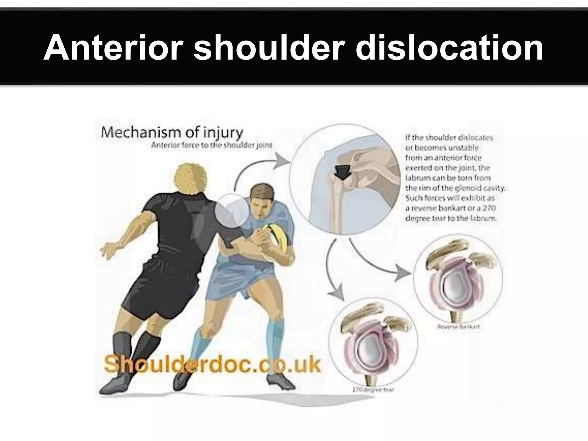 Shoulderdislocation | PPTX