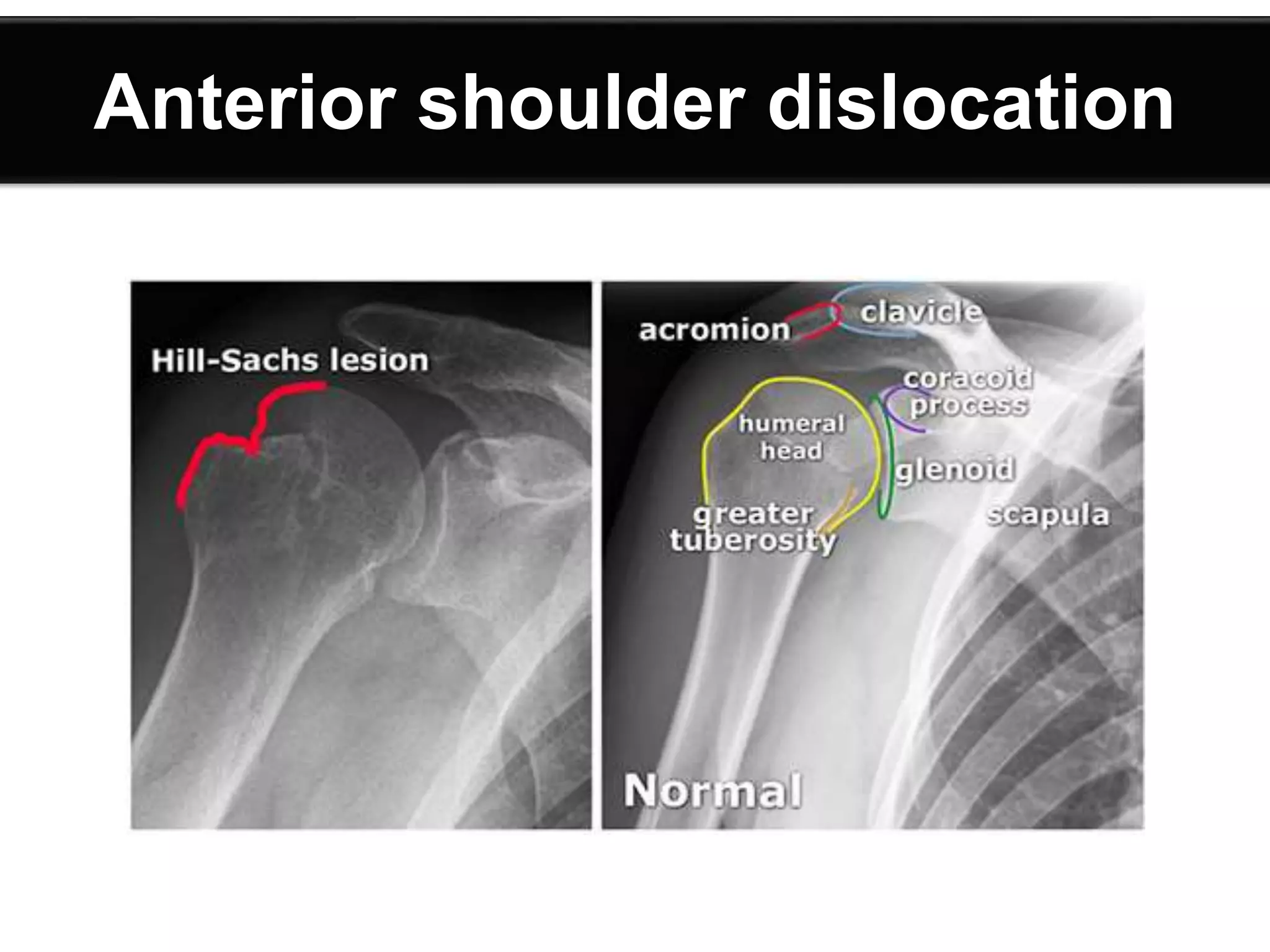 Shoulderdislocation | PPTX