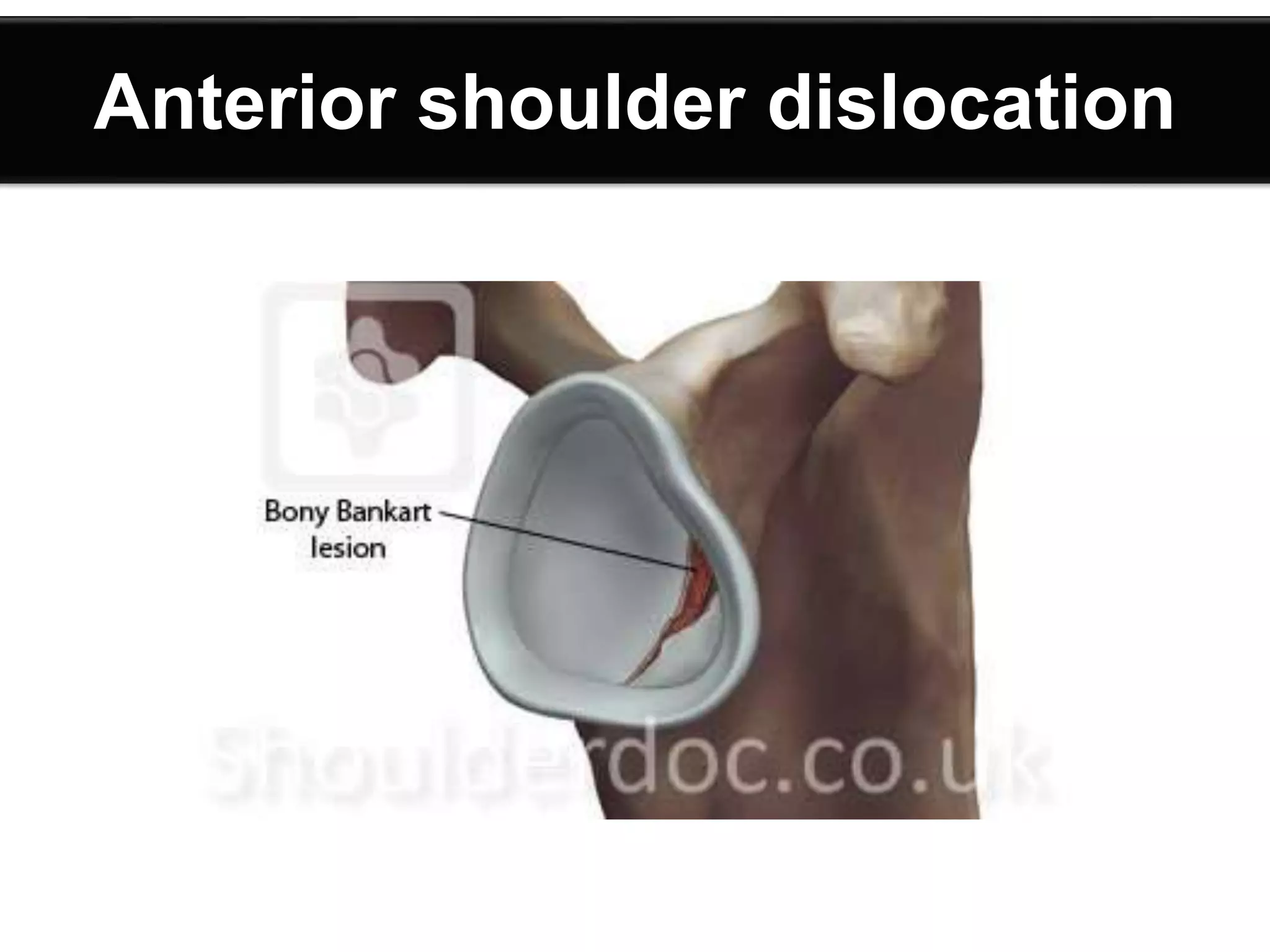 Shoulderdislocation Pptx