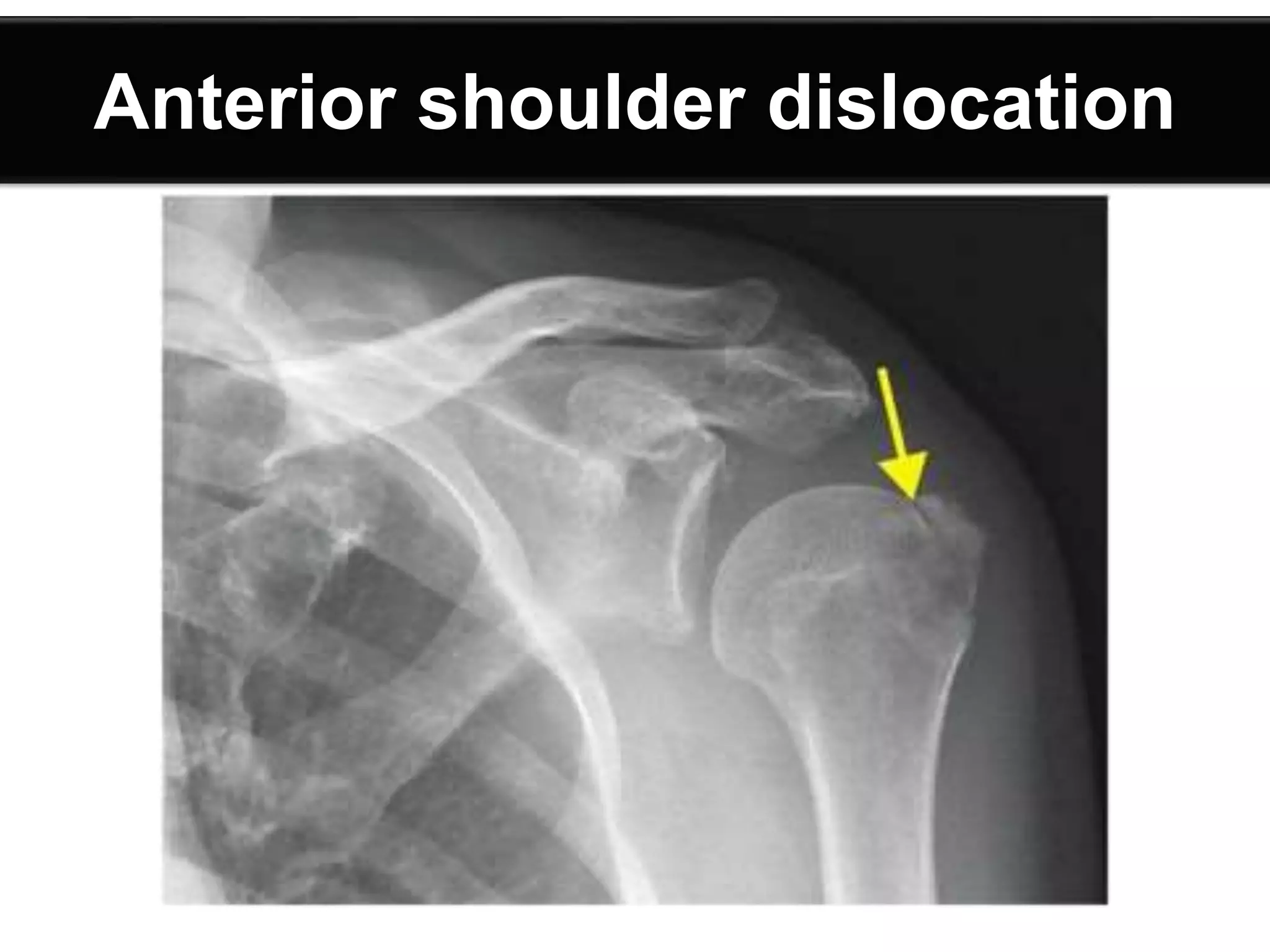 Shoulderdislocation Pptx