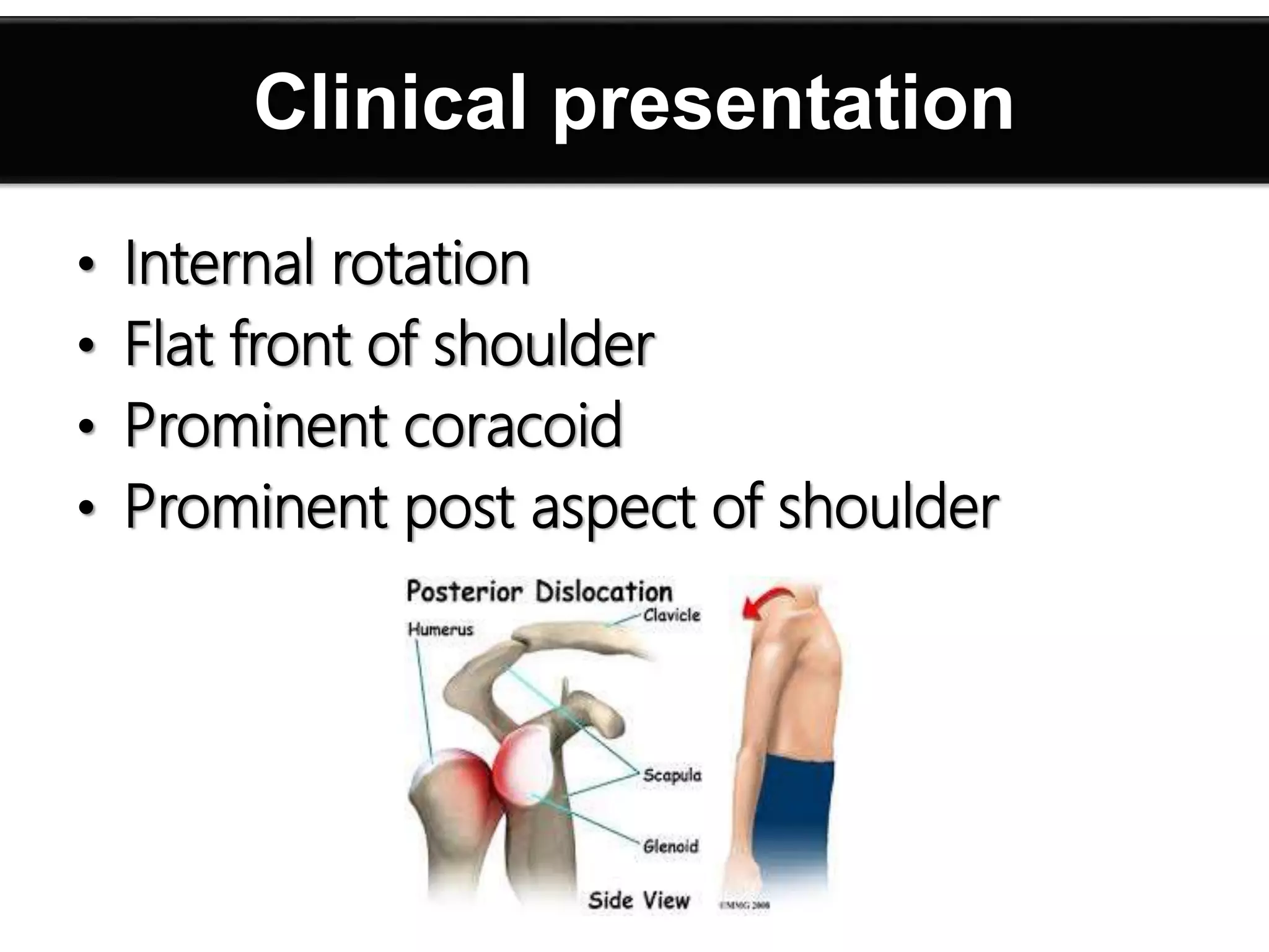 Shoulderdislocation Pptx