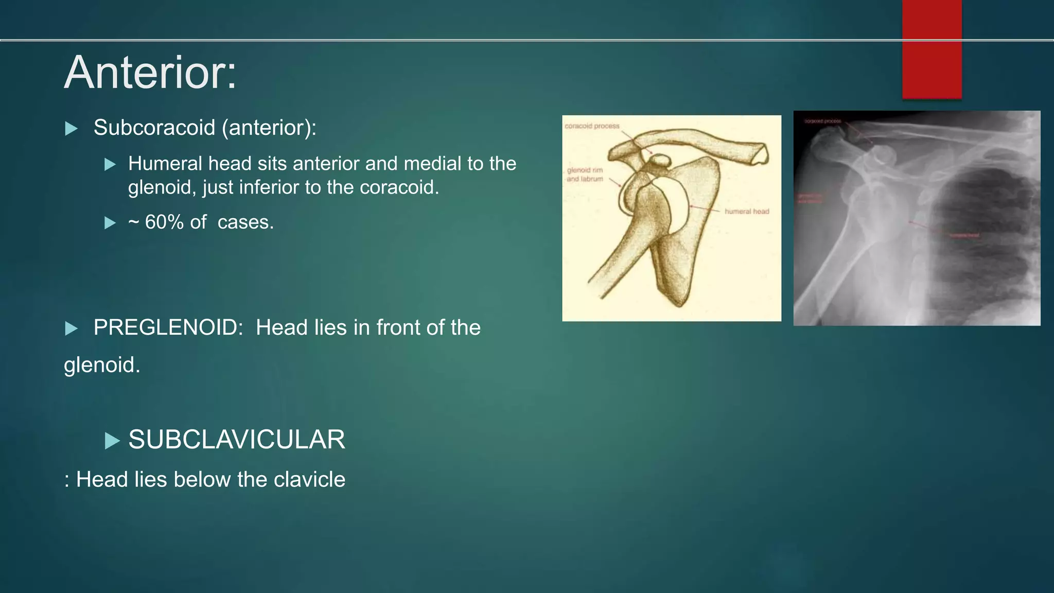 Shoulder dislocation- M.B.B.S | PPTX