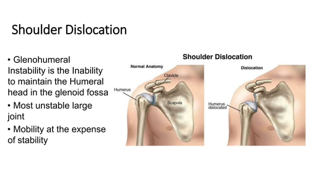 Shoulder dislocation | PPTX