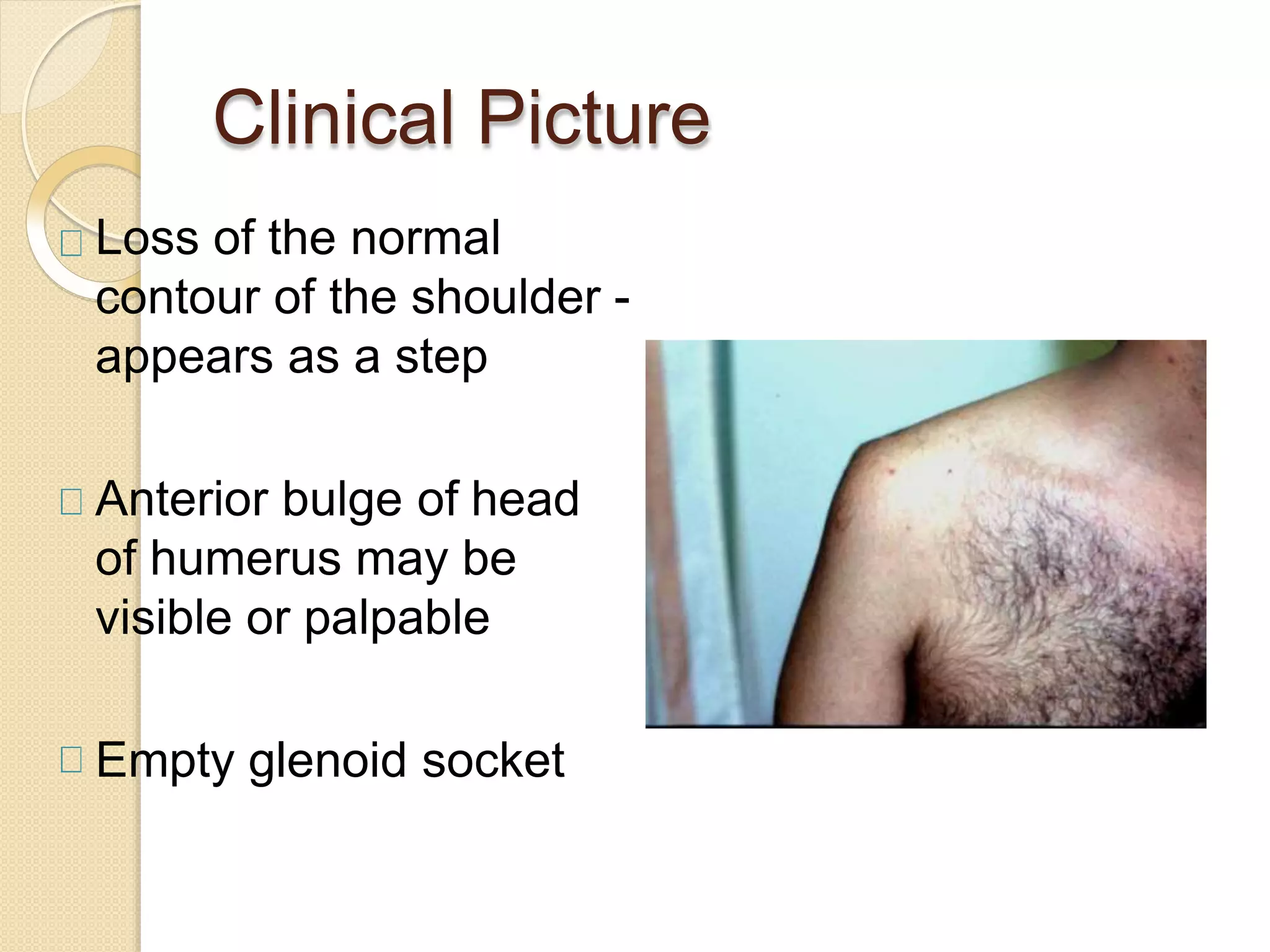 Shoulder dislocation | PPTX