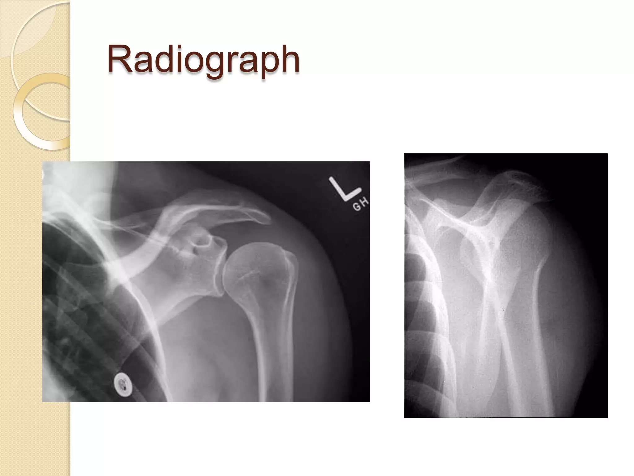 Shoulder dislocation | PPTX