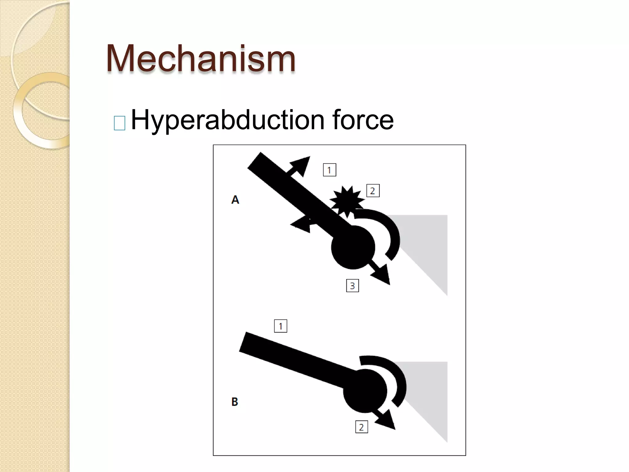 Shoulder dislocation | PPTX