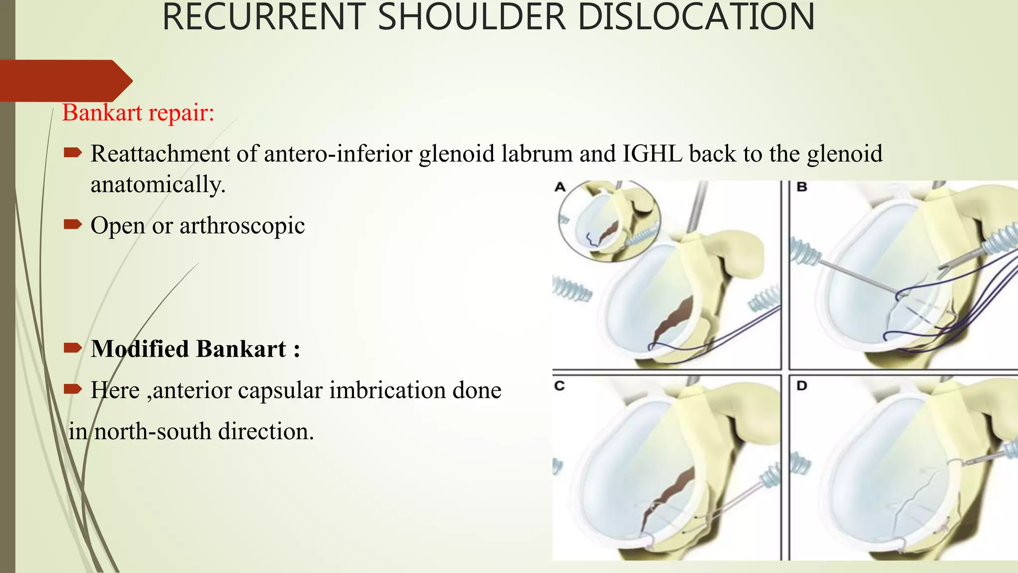 Shoulder dislocation | PPTX