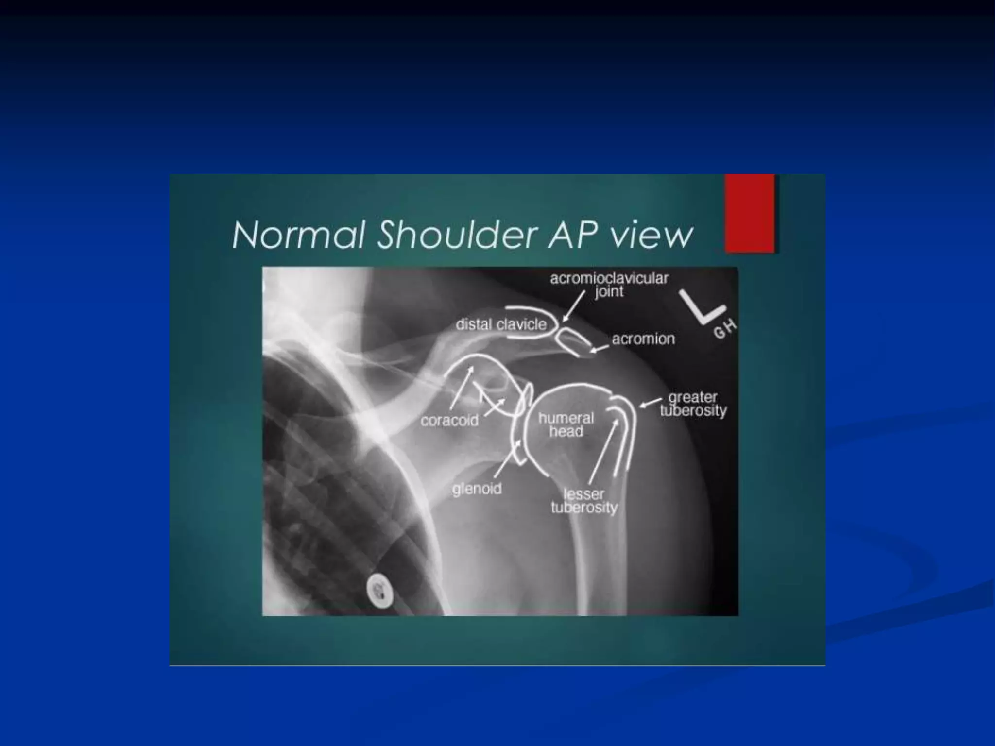 Shoulder_Dislocation.ppt