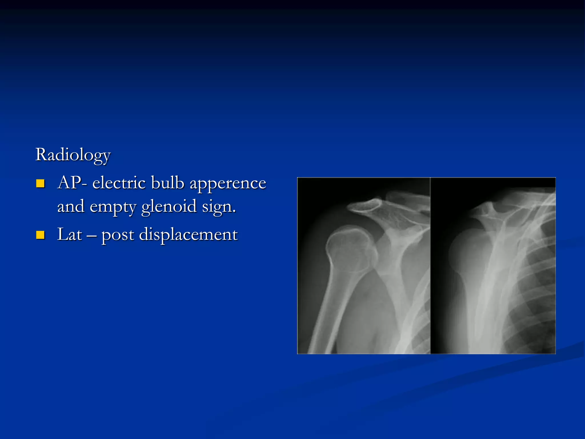 Shoulder_Dislocation.ppt