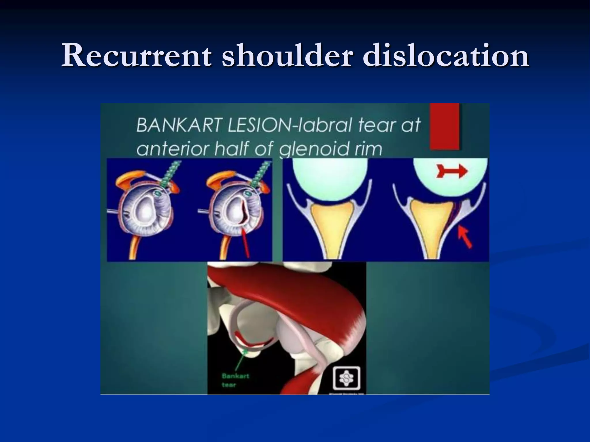 Shoulder_Dislocation.ppt