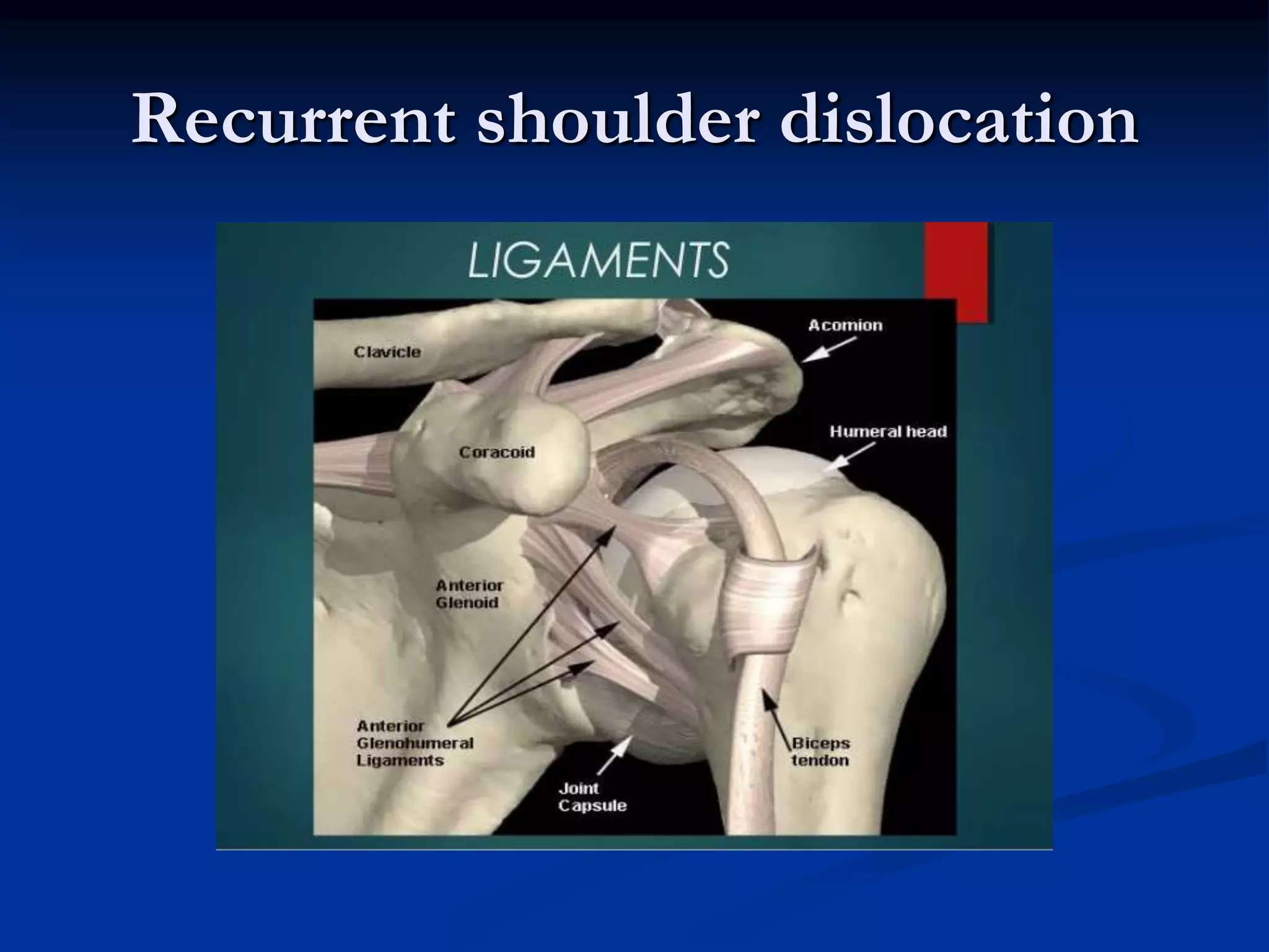 Shoulder_Dislocation.ppt
