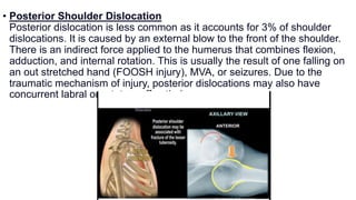 Shoulder dislocation.pptx