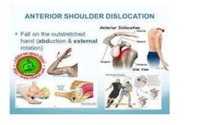 Shoulder dislocation.pptx