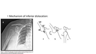 Shoulder dislocation.pptx