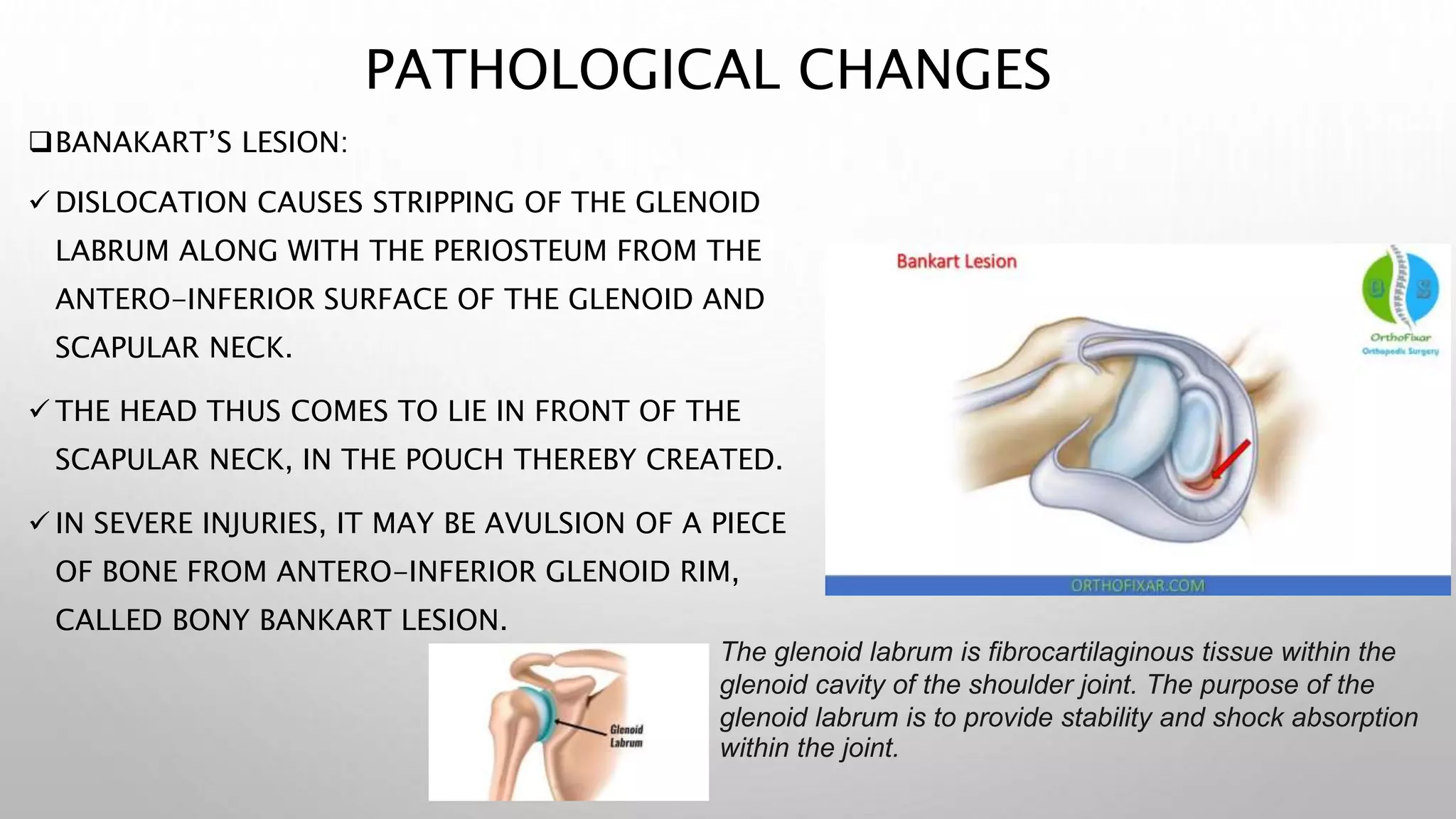 Shoulder dislocation.pptx