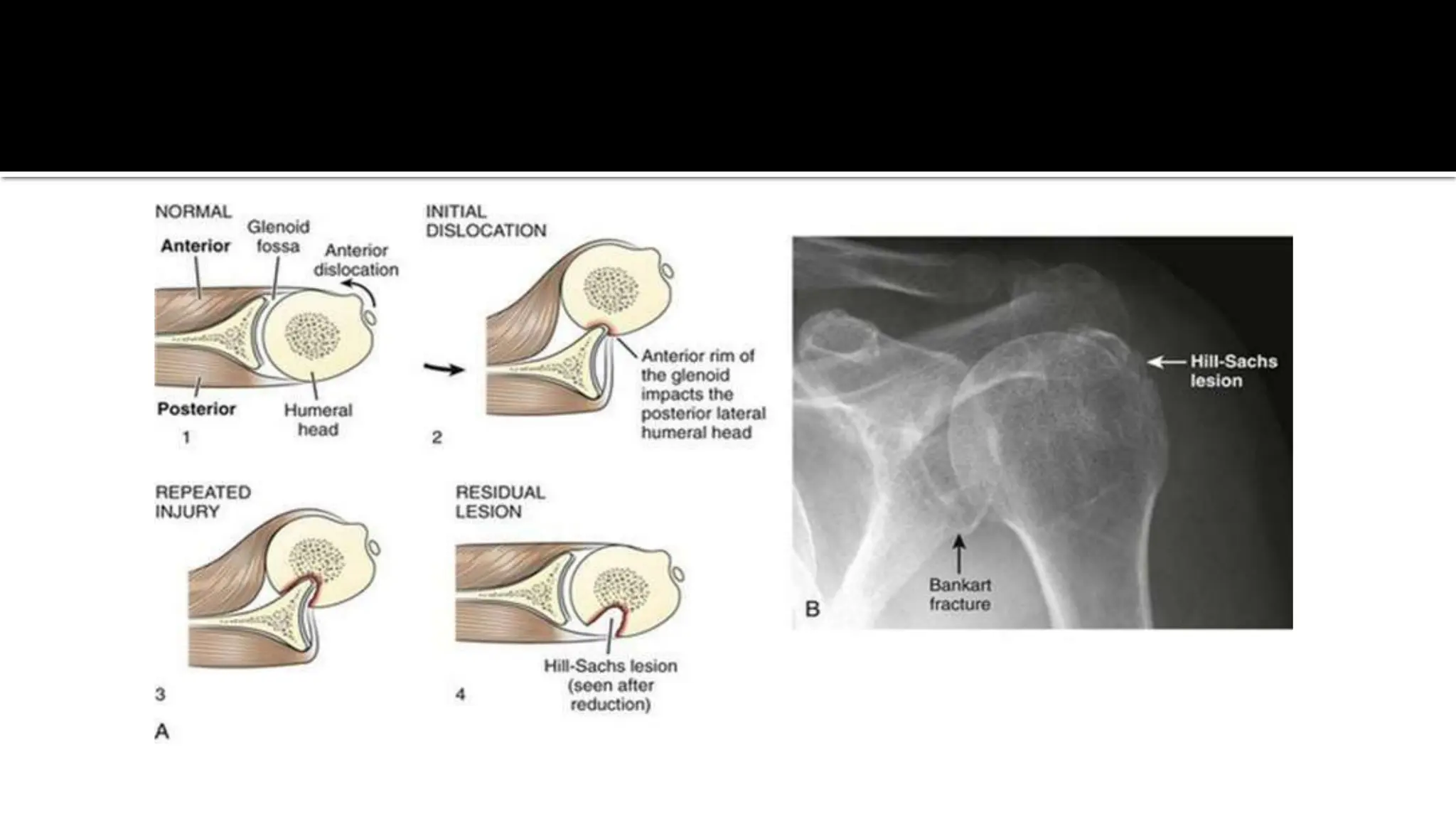 SHOULDER DISLOCATION - Types, Clinical Features | PPTX