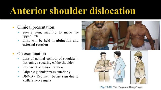 SHOULDER DISLOCATION - Types, Clinical Features | PPTX | Death, Injury ...