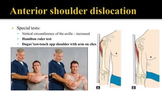SHOULDER DISLOCATION - Types, Clinical Features | PPTX