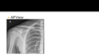 SHOULDER DISLOCATION - Types, Clinical Features | PPTX