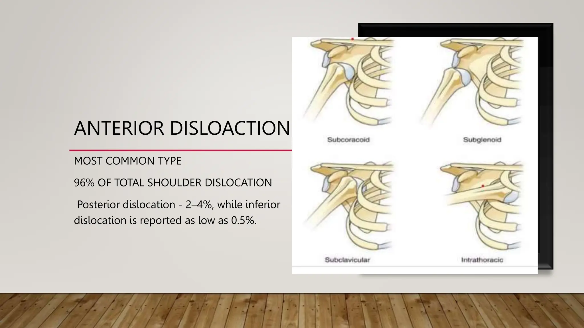 shoulder dislocation and surgical management pptx | PPTX